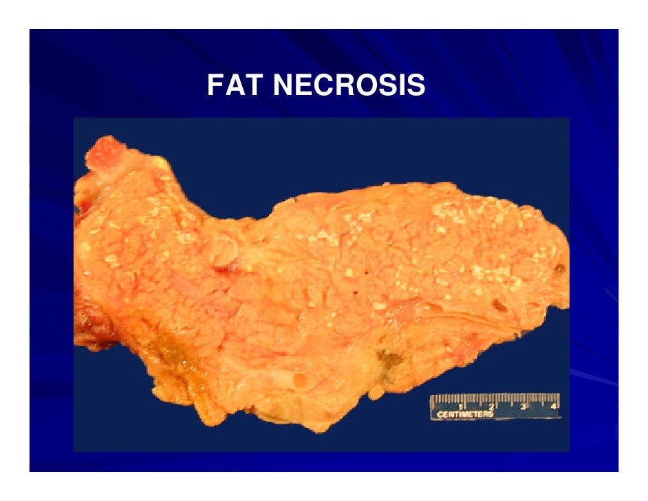 Necrosis