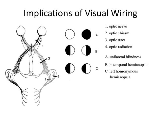 Quadrantenanopsie Therapie Therapie Bei Gesichtsfeldausfall Savir