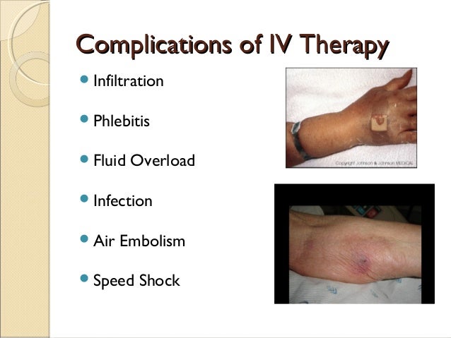 Iv Therapy