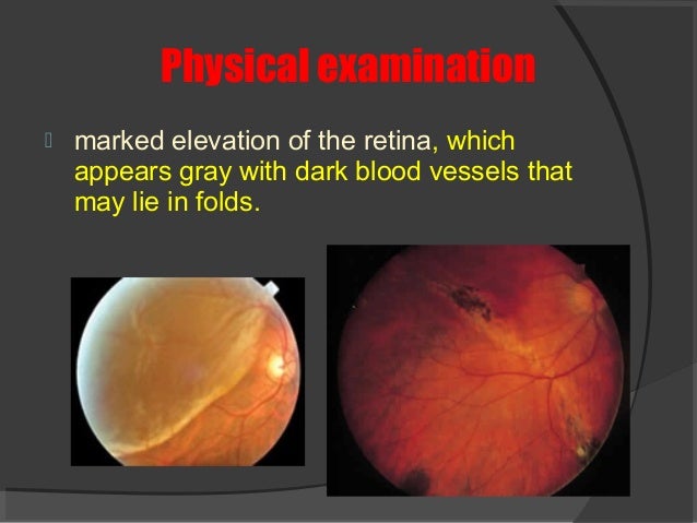 Nw2013 RetinalDetachment