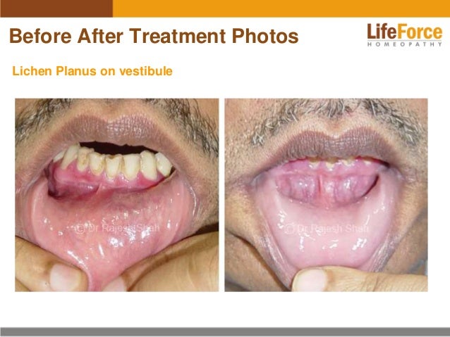 Oral Lichen Planus Photos Before And After Treatment Pictures Of Mou…