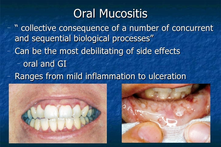 Oral Mucositis In Cancer Care