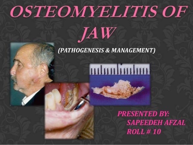 Jaw Bone Infection Symptoms And Osteomyelitis Causes