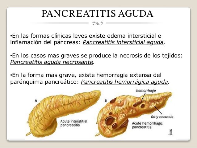 Pancreatitis Aguda y Cronica