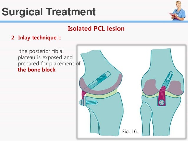 Posterior Cruciate ligament reconstruction, By Emad M. Qasem