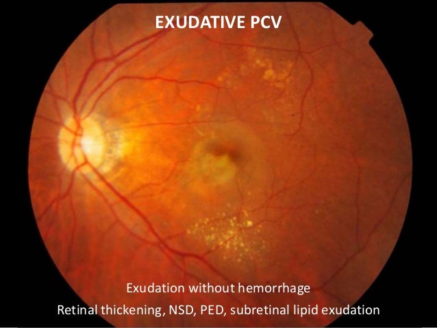 Polypoidal choroidal vasculopathy