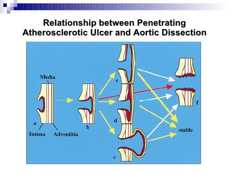 Penetrating Atherosclerotic Ulcer