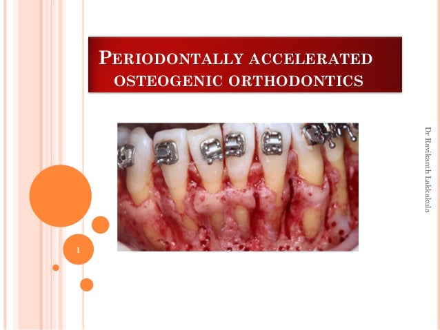 Periodontally accelerated osteogenic osthodontics