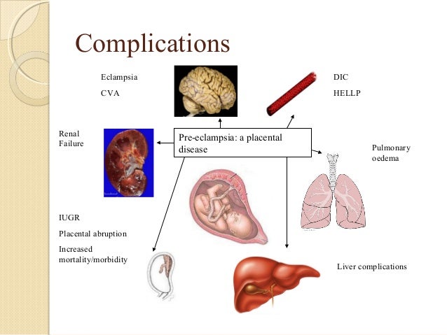 Pre Eclampsia And Hypertensive Disease In Pregnancy