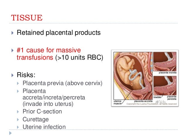 Post Partum Hemorrhage (PPH)