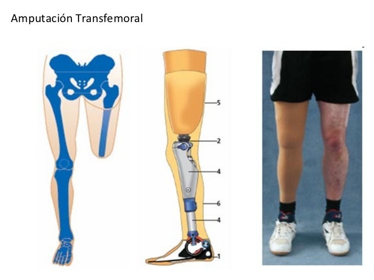 Prótesis Y Rehabilitación De Amputados
