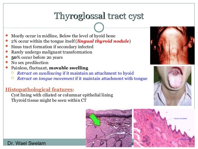 Pseudo Cyst