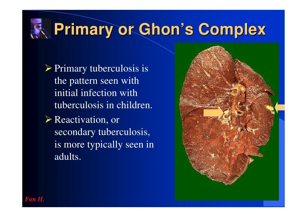 Pulmonary Tuberculosis