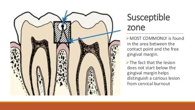 Radiographic Of Interpretation Of Dental Caries