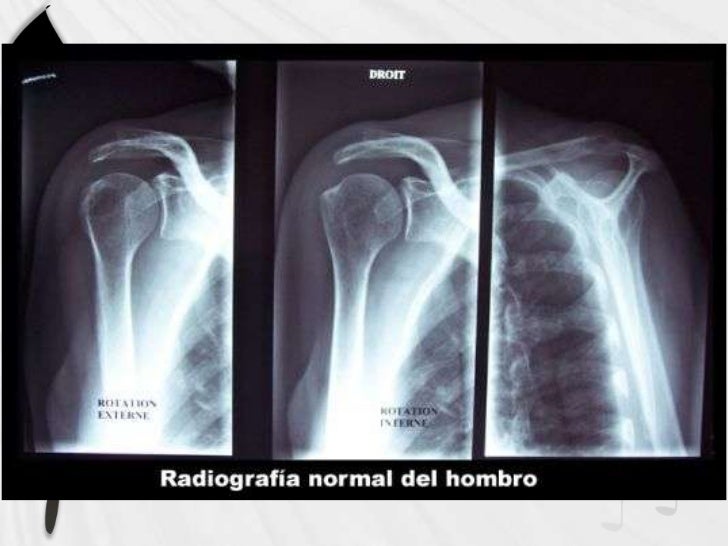 Radiología hombro