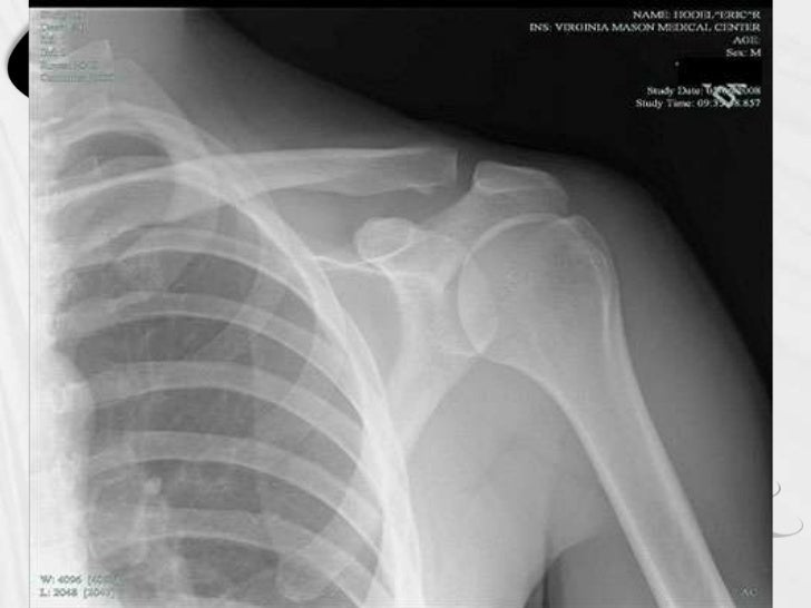 Radiología hombro