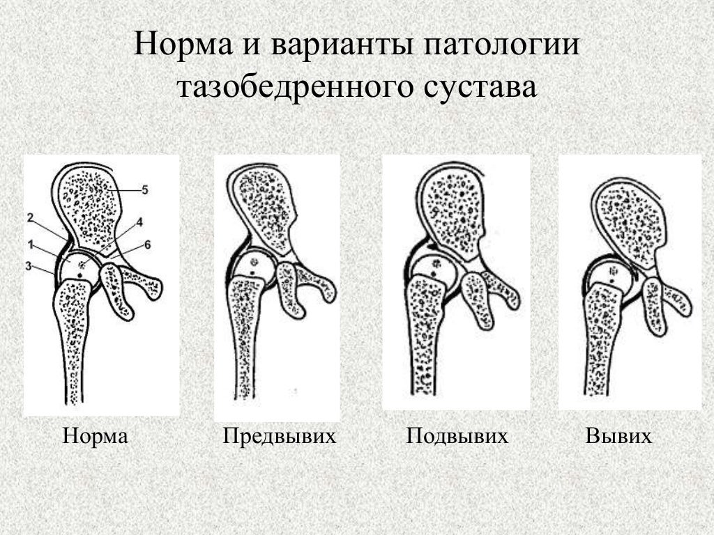 Лечение Подвывиха Тазобедренного Сустава — Buy-artox.ru