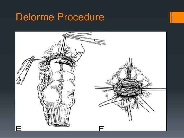 Rectal Prolapse