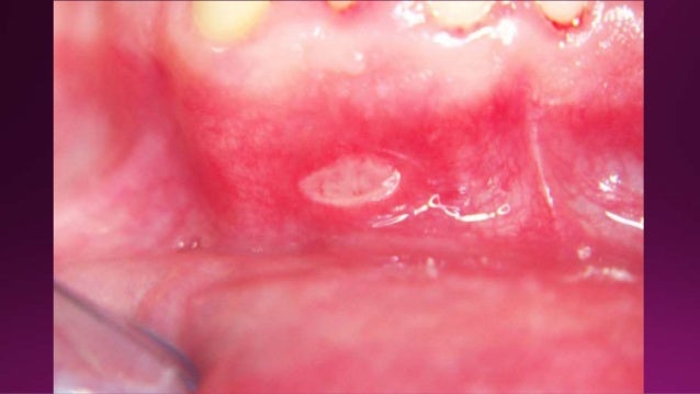 Recurrent aphthous stomatitis