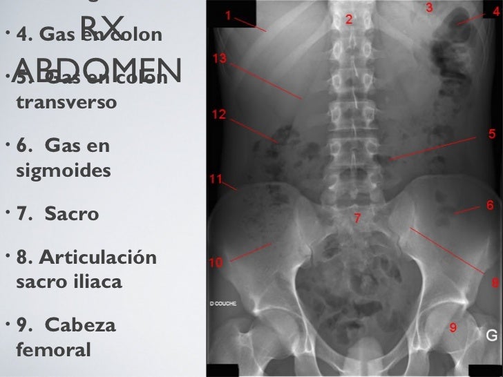 Rx abdomen