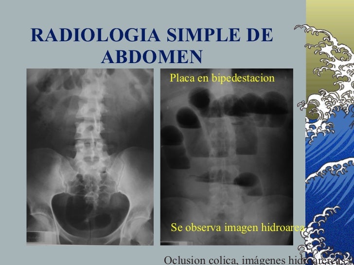 Rx Simple De Abdomen