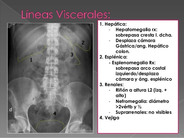 Rx simple de abdomen