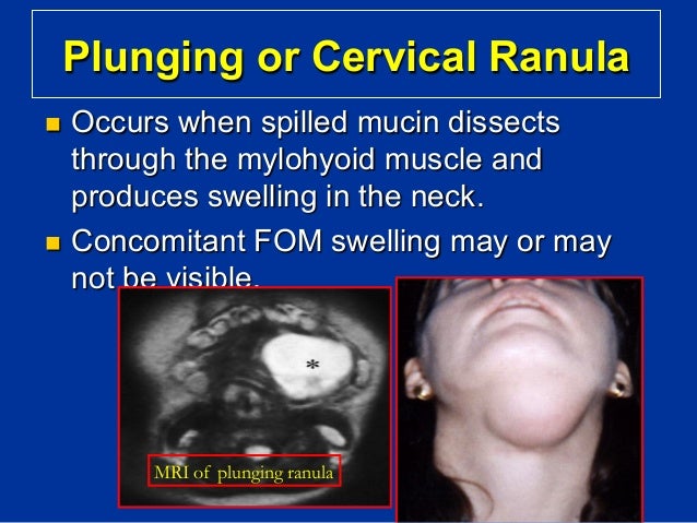 Salivary glands diseases