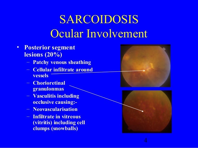 Sarcoidosis