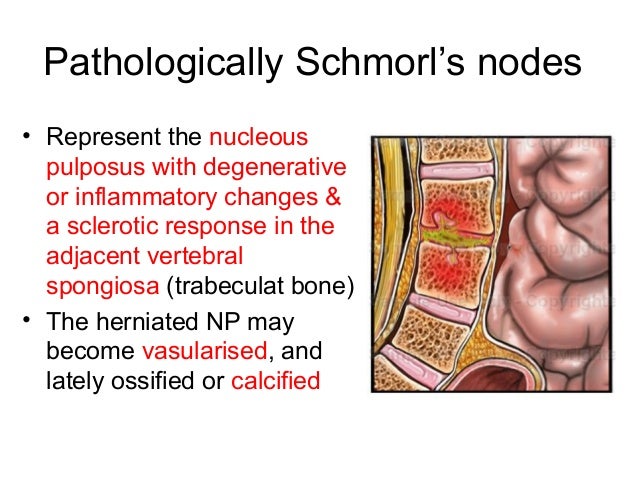 Schmorl’s nodes (spine 2010)