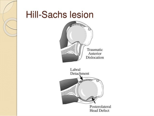 Shoulder Dislocation Saseendar