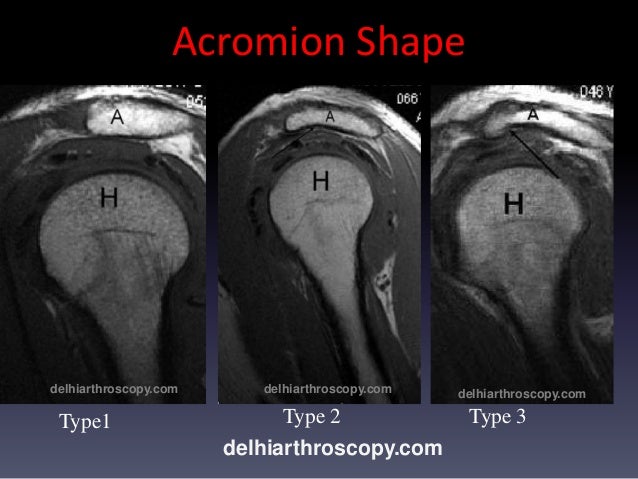 Shoulder Mri Scan in Delhi by Dr Shekhar Shrivastav