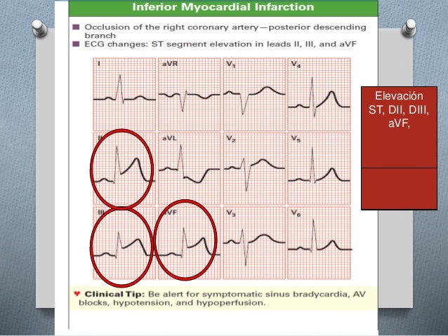Sindrome coronario agudo con elevacion del ST