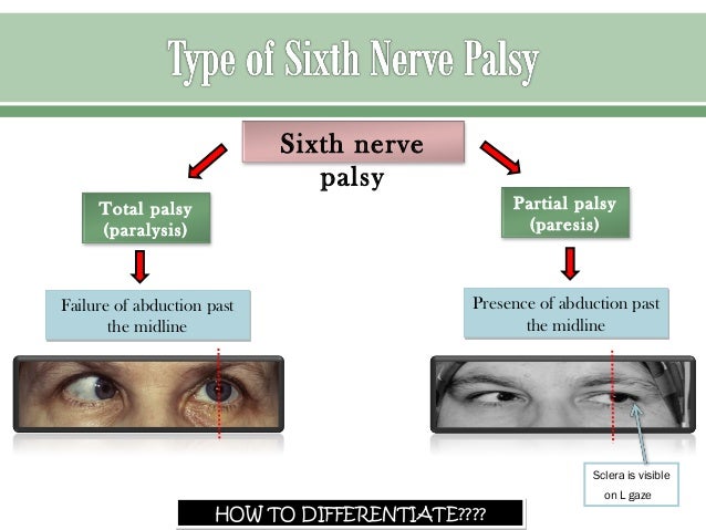 Sixth nerve palsy