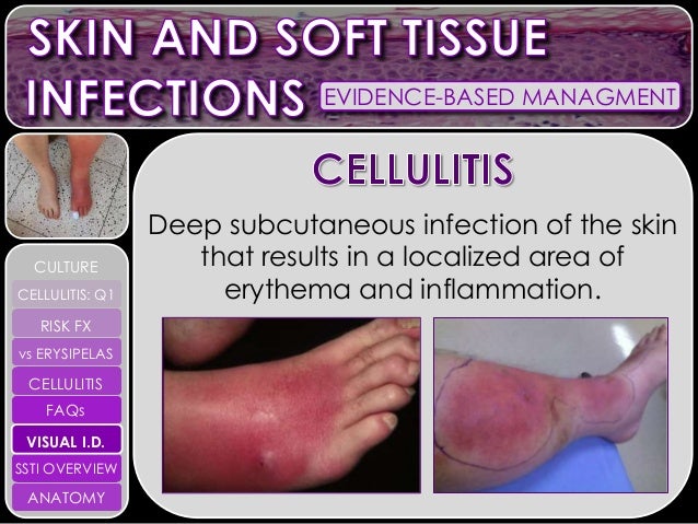 Skin And Soft Tissue Infections