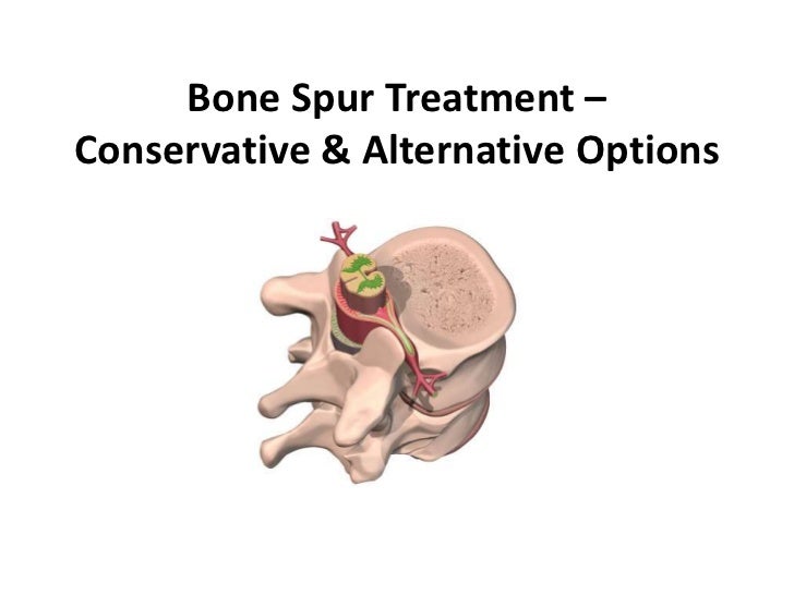 Spinal Bone Spur Treatment Methods