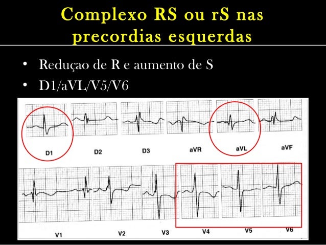 Sobrecargas ventriculares ao ECG - Dra Tatiana Caus
