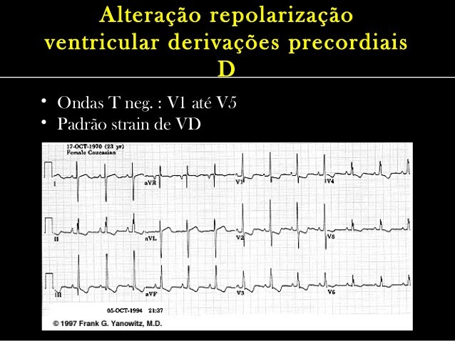 Sobrecargas ventriculares ao ECG - Dra Tatiana Caus
