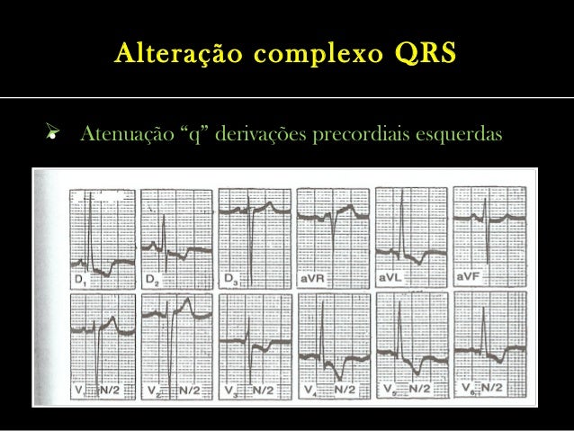 Sobrecargas ventriculares ao ECG - Dra Tatiana Caus