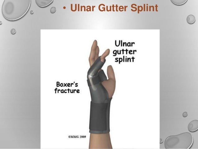 Ulnar Gutter Splint Cast Ulnar Gutter Splint Cast