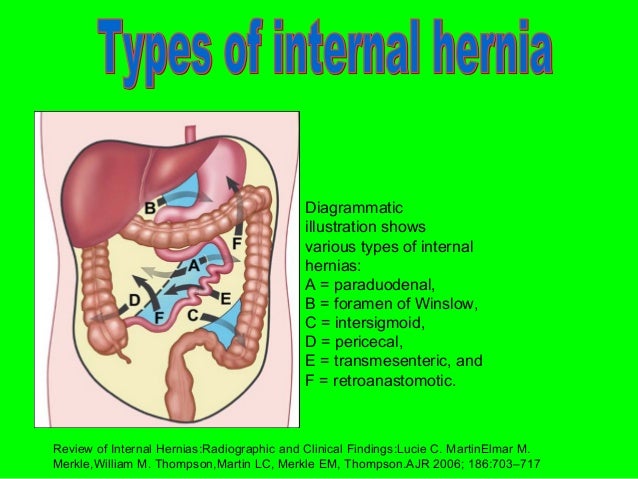 Squeezed through holes: imaging of internal hernia