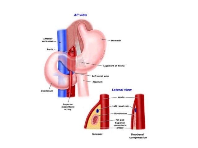 Superior Mesenteric Artery Syndrome