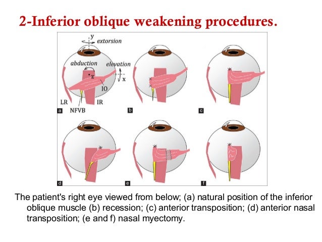 Superior Oblique Palsy Superior Oblique Palsy