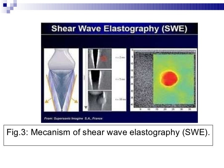 SHEAR WAVE ELASTOGRAPHY of BREAST TUMORS