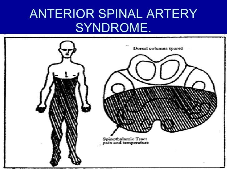 Syndromes Of Spinal Cord