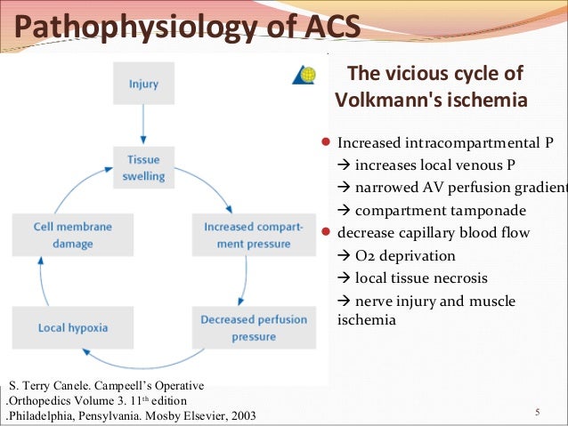 Compartment syndrome, acute, chronic, anatomy and operation