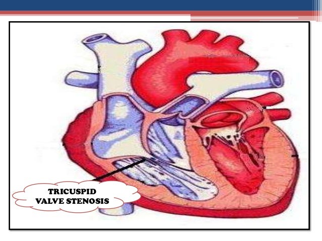 Tricuspid Valve Stenosis