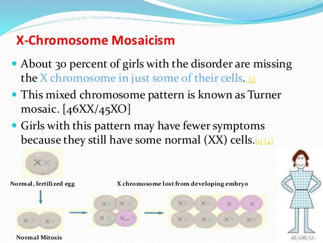 Turner Syndrome