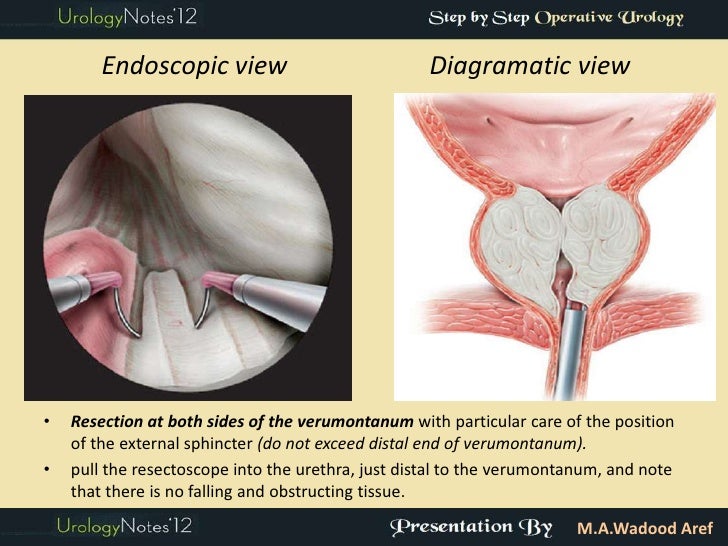 TURP Step By Step Operative Urology TURP Step By Step Operative Urology