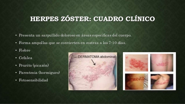 Varicela Y Herpes Zóster