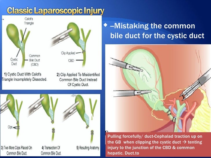 BILE DUCT INJURY DURING LAPAROSCOPIC cholecystectomy- causes-detectio…